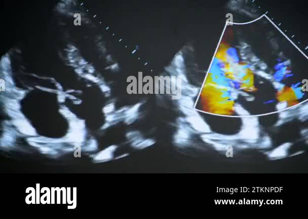 Utrasound image on the monitor close-up. Ultrasound Scan display ...