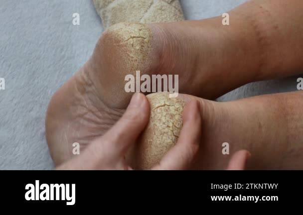 Human foot heels with dry cracked problematic skin. Close-up of female ...