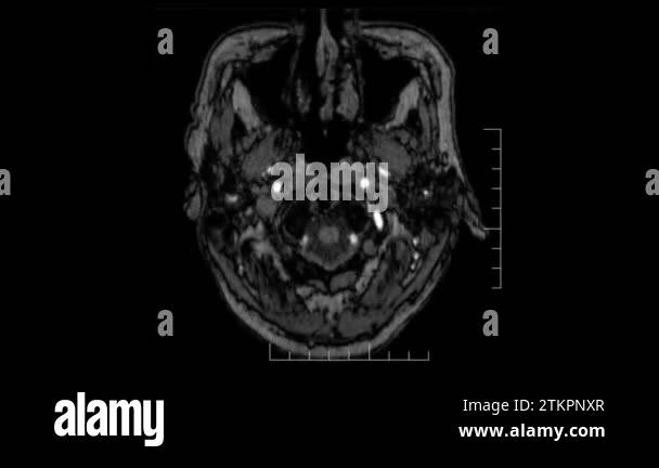 Mri scans brain Stock Videos & Footage - HD and 4K Video Clips - Alamy
