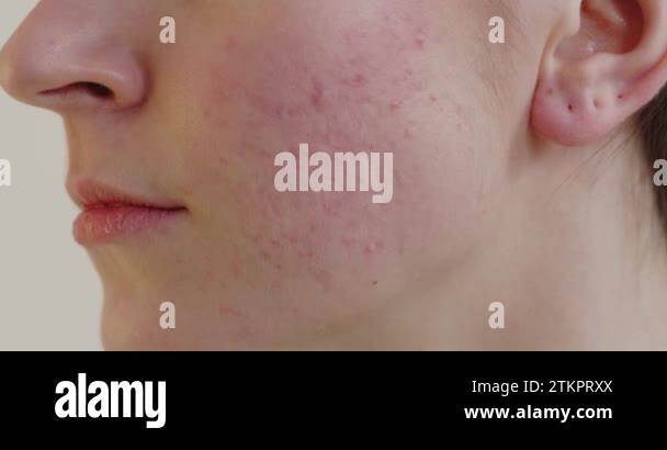Close up view of woman acne skin caused by hormone. Red rash on young ...