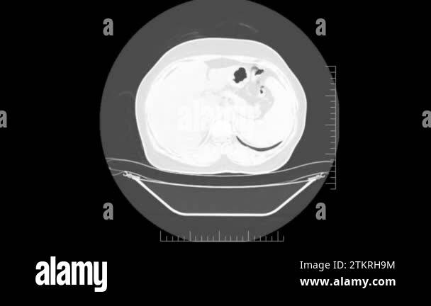 Voluminous CT scan of the abdomen. Computed tomography of the ...