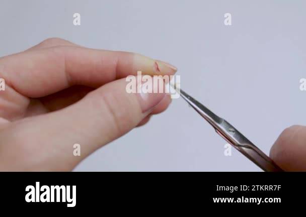 Remove the torn edges of the wound with scissors. Close-up. First aid ...