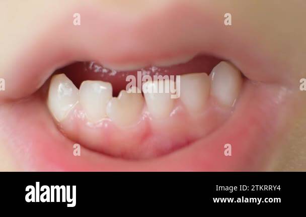 Child incisor teeth Stock Videos & Footage - HD and 4K Video Clips - Alamy