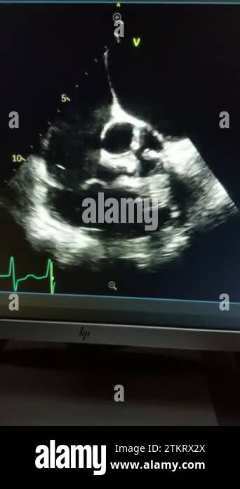 Transesophageal echocardiogram Stock Videos & Footage - HD and 4K Video ...