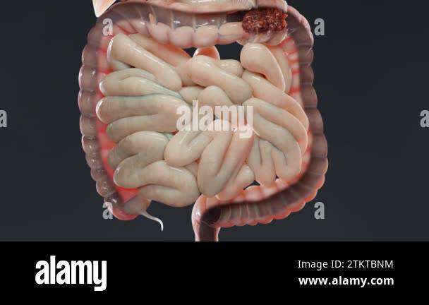 Human Anatomy Digestion, concept of the intestine, laxative, traitement ...