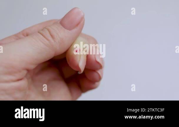 Wound on the index finger after the band-aid. Close-up. First aid for ...