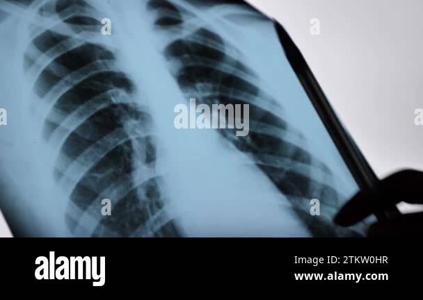 Normal chest x ray Stock Videos & Footage - HD and 4K Video Clips - Alamy