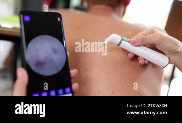Dermatologist examines patient skin using digital dermatoscope and ...