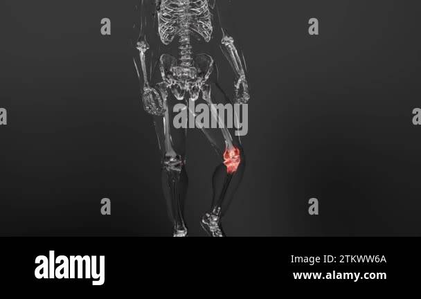 Pain in the arthritic knee joint, Knee painful, skeleton x-ray ...