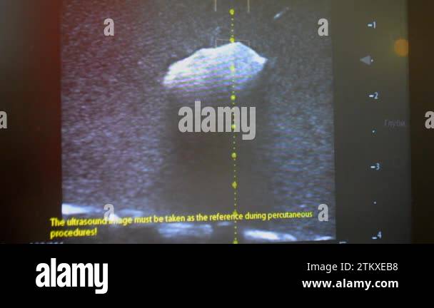 Utrasound image on the monitor close-up. Ultrasound Scan display ...