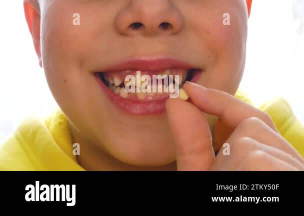 The child holds the newly fallen milk tooth opposite the mouth. The ...
