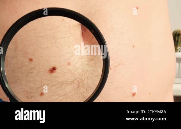 Mole dermoscopy preventive melanoma Stock Videos & Footage - HD and 4K ...
