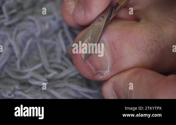 Fungal infection on legs Stock Videos & Footage - HD and 4K Video Clips ...