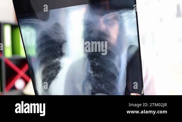 X ray chest infection Stock Videos & Footage - HD and 4K Video Clips ...