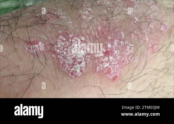 Pustular psoriasis Stock Videos & Footage - HD and 4K Video Clips - Alamy