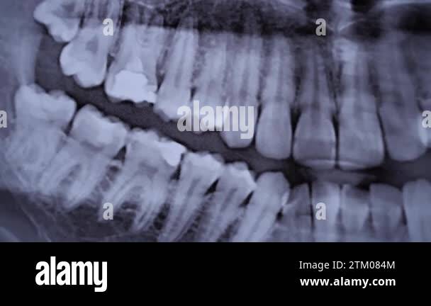 X-ray image of the jaw of all human teeth close-up. Magnetic resonance ...