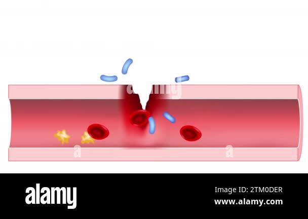 Sepsis. Close-up of cross section of blood vessel with Bacterial ...