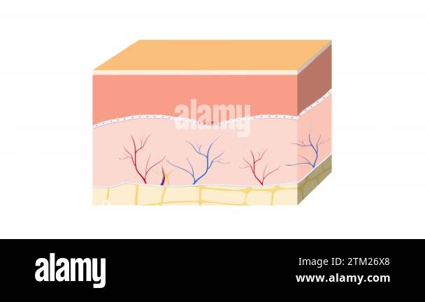 Skin cancer. basal-cell malignant tumor (begins in the basal cells ...
