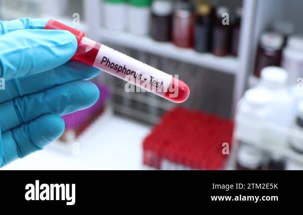 Phosphorus test to look for abnormalities from blood, blood sample to ...