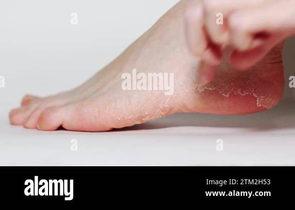 Skin peeling on sole Stock Videos & Footage - HD and 4K Video Clips - Alamy