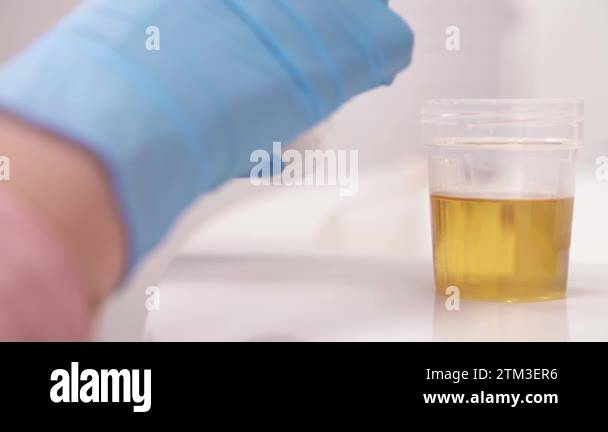 A close-up of a medical laboratory scientist diagnosing of ketonuria by ...