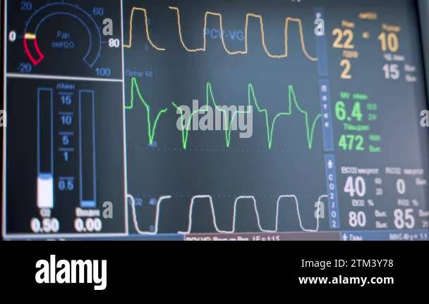 Screen of monitor during surgery in operating room. Emergency room with ...