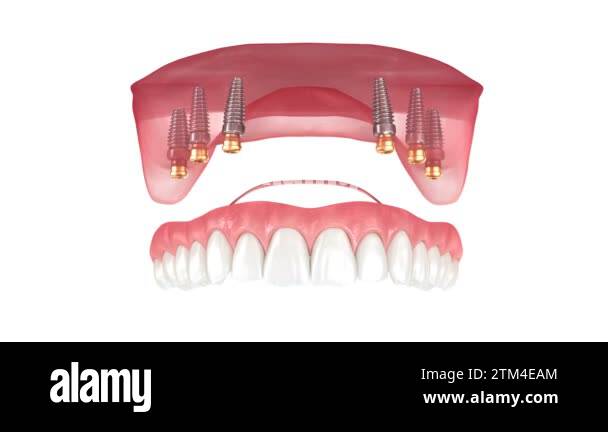 Removable prosthesis with gum All on 6 system supported by implants ...