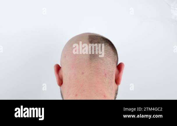 Bald man, rear view. Baldness close-up. Loss of hair on the head. Bald ...