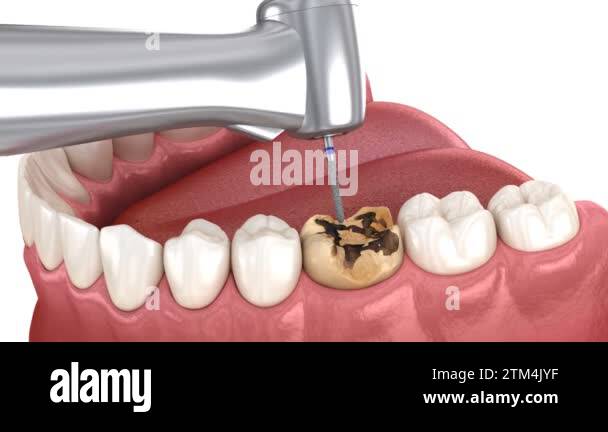 Caries removing, preparation, dental impression and crown placement. 3D ...