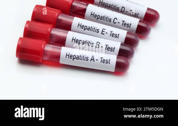 Hepatitis test to look for abnormalities from blood, scientific ...