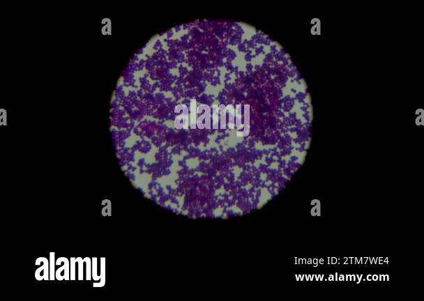 Smear of biological sample culture Gram's stained with gram positive ...