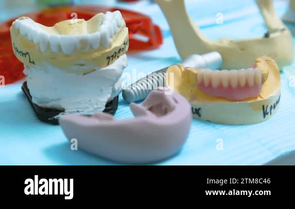 Teeth casts Stock Videos & Footage - HD and 4K Video Clips - Alamy
