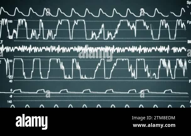 Modern patient monitor. Electronic Health Monitor displaying medical ...