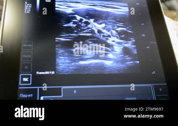 Ultrasound on monitor. Ultrasound image on computer monitor screen ...