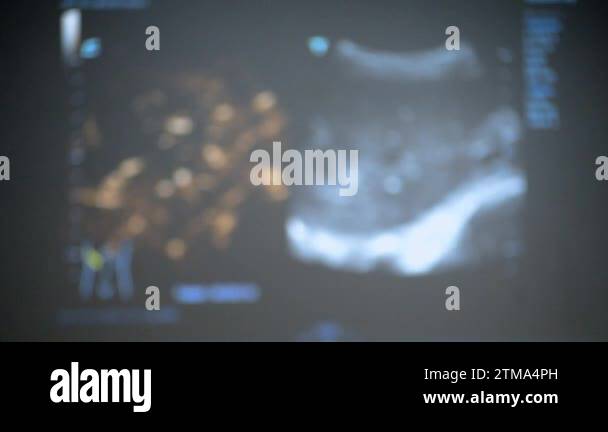 Blurred background. Utrasound image on monitor. Ultrasound Scan display ...