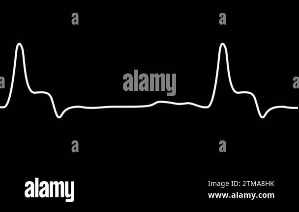 Pulse of the heartbeat white color. EKG Monitor. Heart beat cardiogram ...