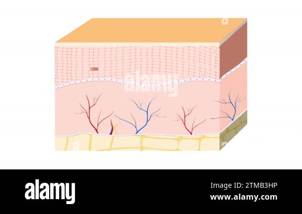 Squamous Cell Carcinoma. Skin cancer. Squamous cell carcinoma ...