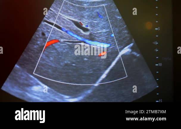 Ultrasound on monitor. Ultrasound image on computer monitor screen ...