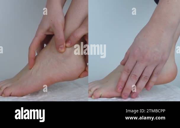 Achilles tendon bursitis Stock Videos & Footage - HD and 4K Video Clips ...