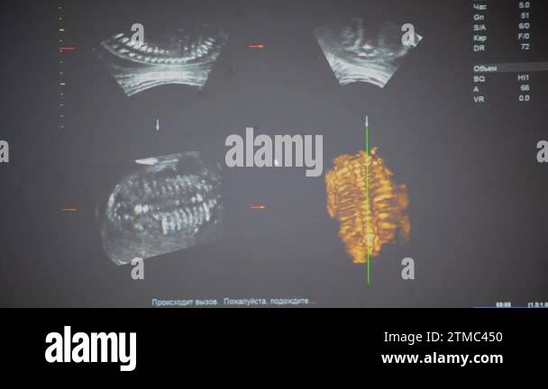 Ultrasound on monitor. Ultrasound image on computer monitor screen ...