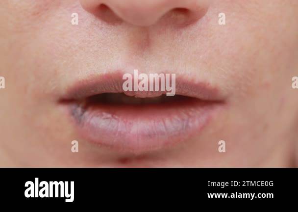 female lips with bruise. close-up. effects of hyaluronic acid. lip ...