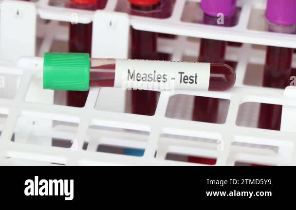 Measles test, blood sample to analyze in the laboratory, blood in test ...