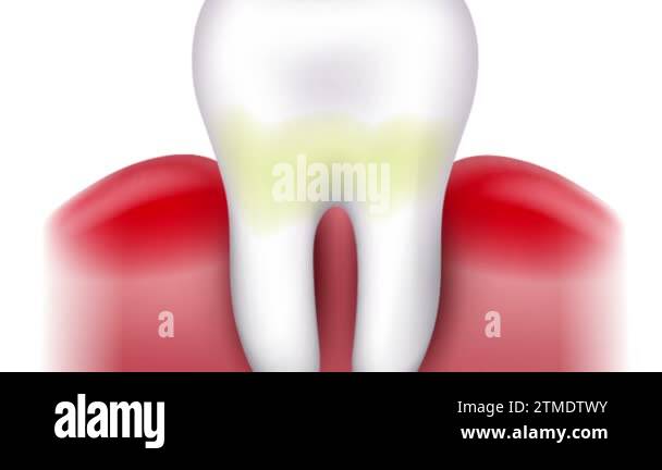Tooth caries formation, dental plaque, loss of calcium, phosphate and ...