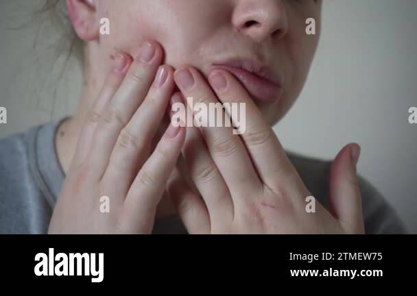 Close up of skin problems, unhealthy skin with acne and pimples. Porous ...