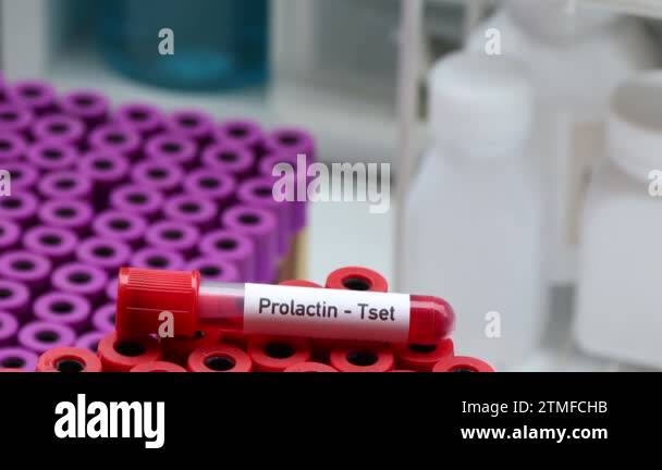 Prolactin test to look for abnormalities from blood, blood sample to ...