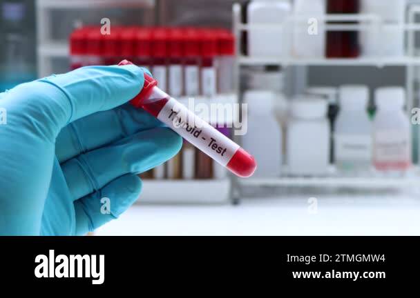 Thyroid test to look for abnormalities from blood, blood sample to ...