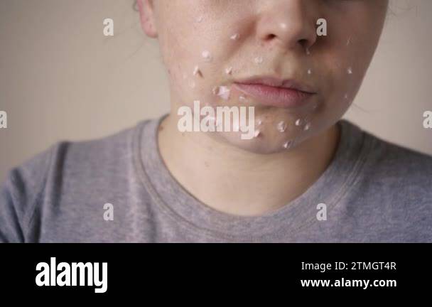 Close up of skin problems, unhealthy skin with acne and pimples. Porous ...