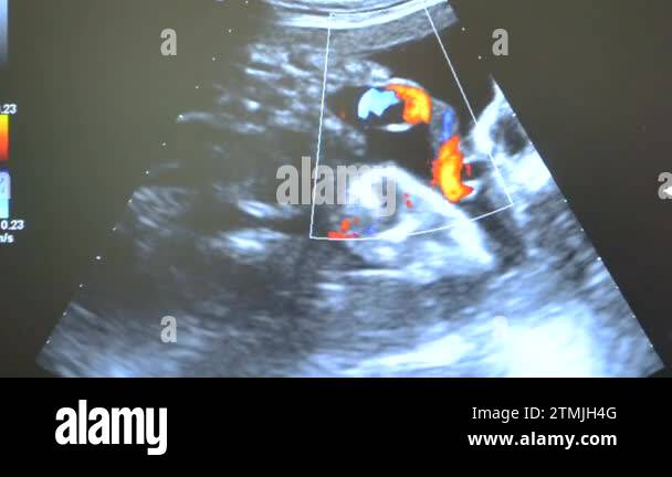 Ultrasound on monitor. Ultrasound image on computer monitor screen ...