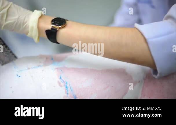 Prosthetic technician sculpting plaster cast for socket at prosthetic production factory, High ...