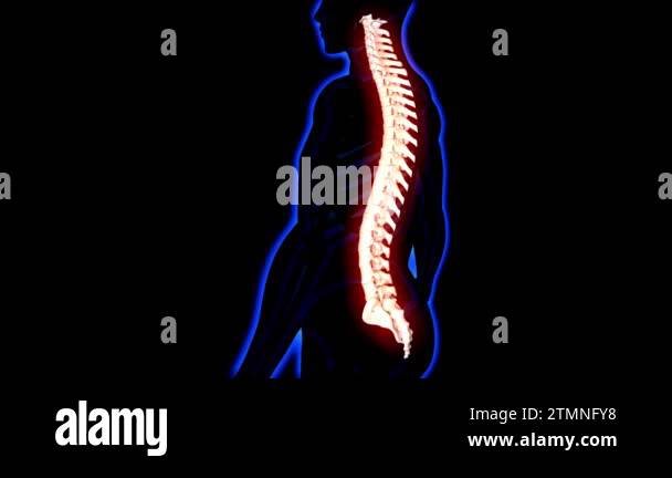 Animation background of painful back VFX Back Pain Augmented Reality ...